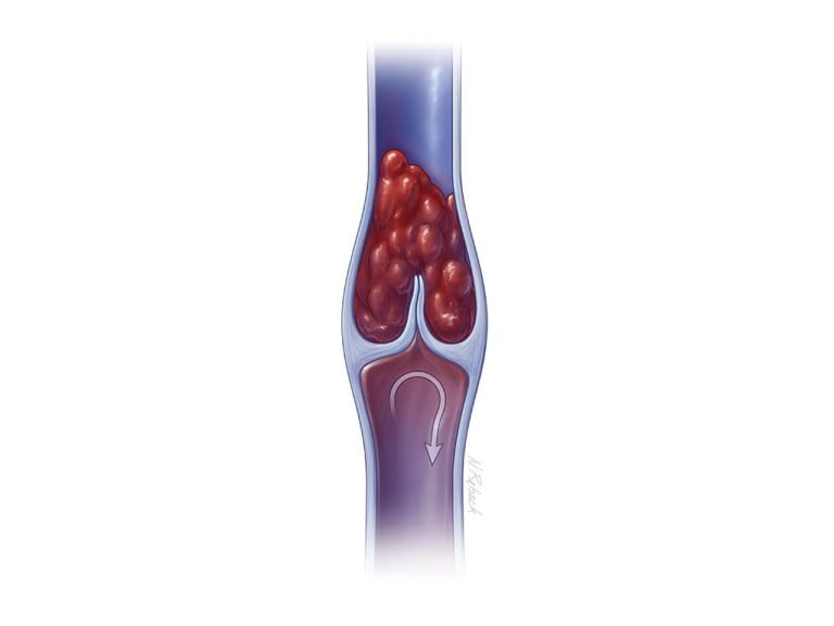 Trombose e cirurgia plástica: entenda tudo a respeito!