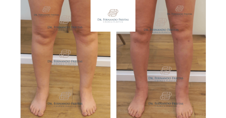 Lipedema antes e depois - Dr. Fernando Freitas